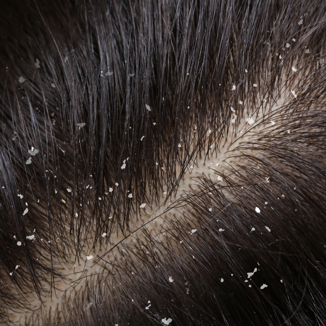 Dermatite séborrhéique du cuir chevelu : comment contrôler durablement ...