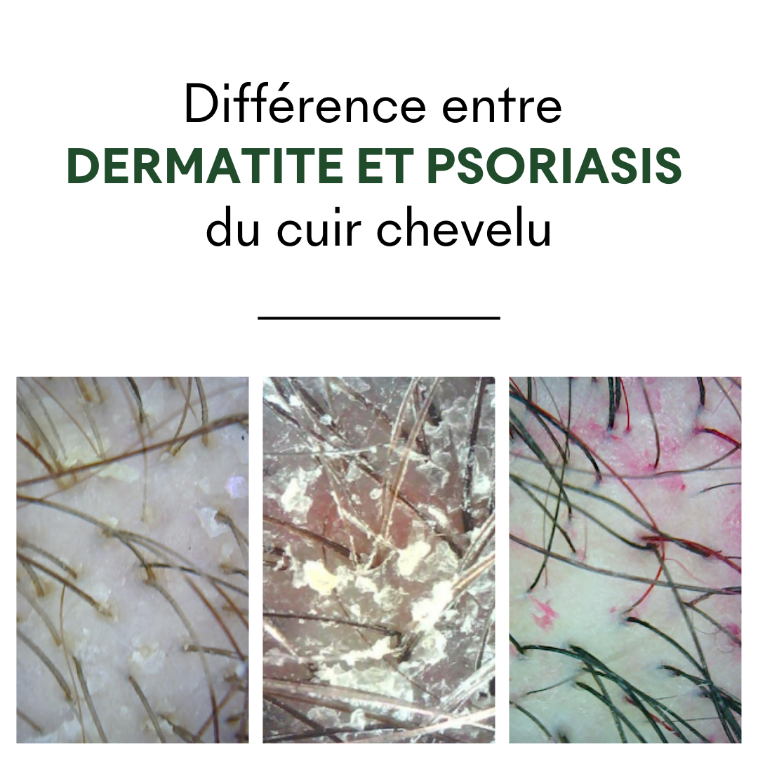 Dermatite VS psoriasis du cuir chevelu : comment les reconnaître ...
