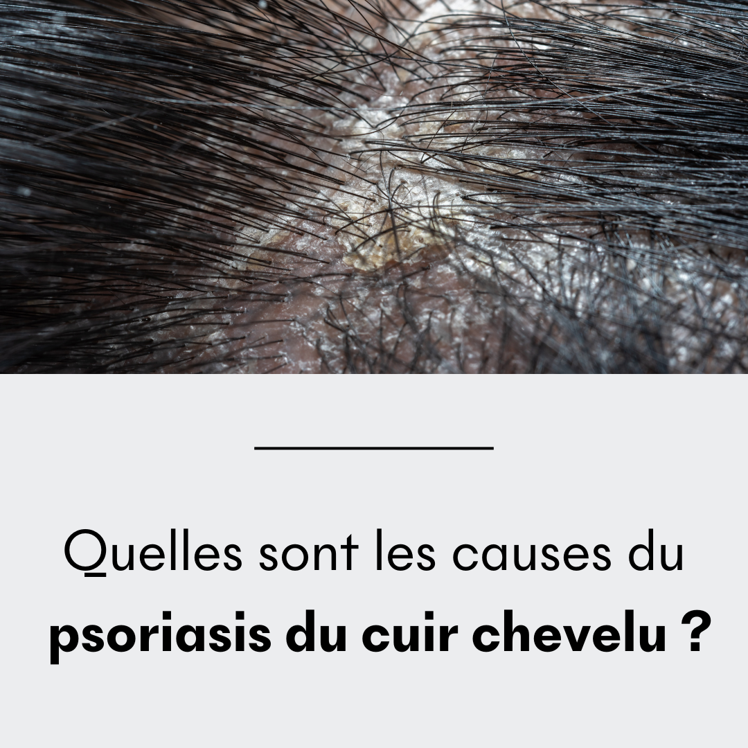 Quelles sont les causes du psoriasis du cuir chevelu ? – MakeMyMask