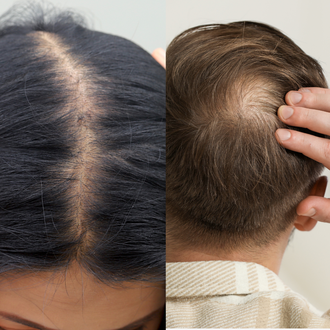 Calvitie chez l’homme VS chez la femme : quelles solutions efficaces ...